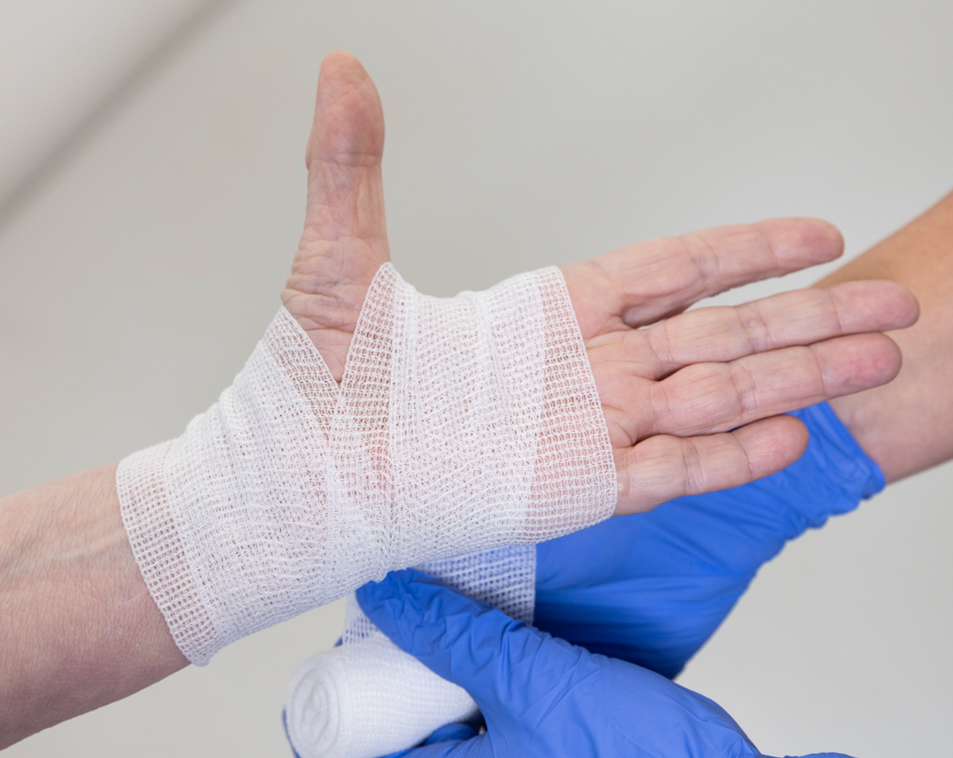 Tendovaginitis stenosans de Quervain, - Die Handchirurgie